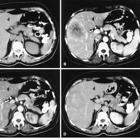 Abdominal Ultrasound Image Shows A Heterogeneous Hyperechoic Mass