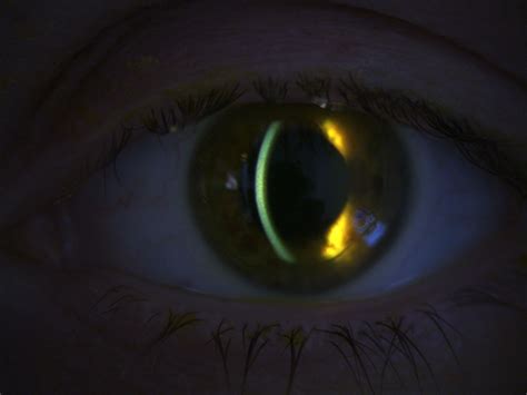 Photrexa Laser Vision Correction Laser Vision Institute