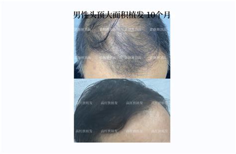 植发让人年轻的案例 知乎