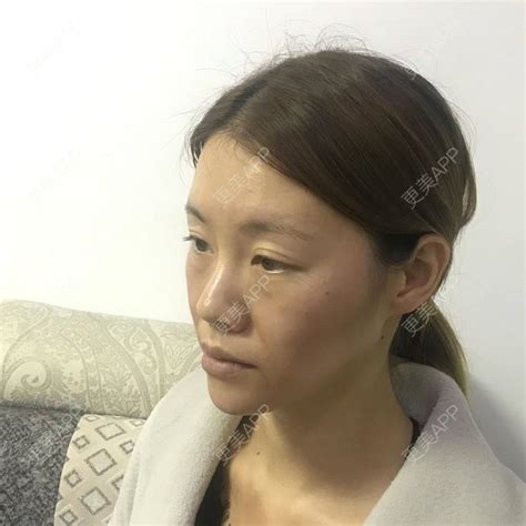 埋线提升前后对比照更美用户wipzdrvt0j埋线提升前后对比照术后219天更美