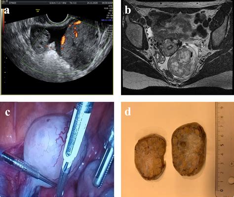 Sclerosing Stromal Tumor Of The Ovary Two Case Reports And Literature