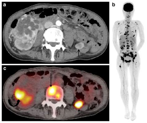 A 62 Year Old Woman With Multiple Bone Metastases And A Retroperitoneal