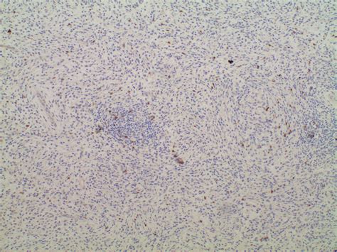 Pathology Outlines Inflammatory Fibroid Polyp