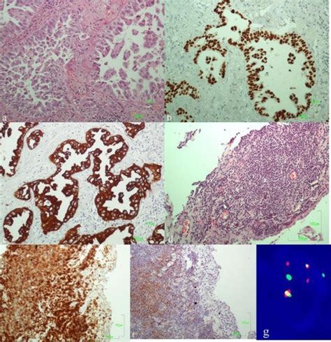 Lung Adenocarcinoma With Micropapillary Pattern A E And H Neoplastic