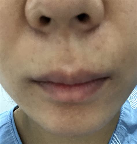 라이크성형외과수술후기