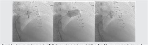 Figure 2 From Failed Bioprosthetic Tricuspid Valve Replacement Treated