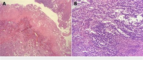 Lung Biopsy Showing Benign Pulmonary Parenchyma With Extensive Download Scientific Diagram