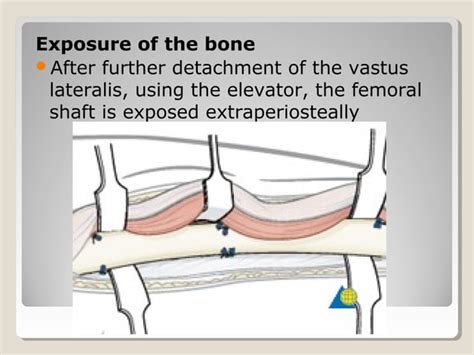 Teknik Operasi Orif Femur Ppt
