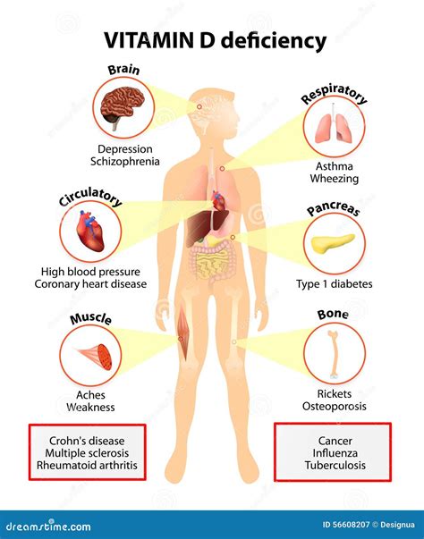 Deficiencia De La Vitamina D Síntomas Y Enfermedades Ilustración Del