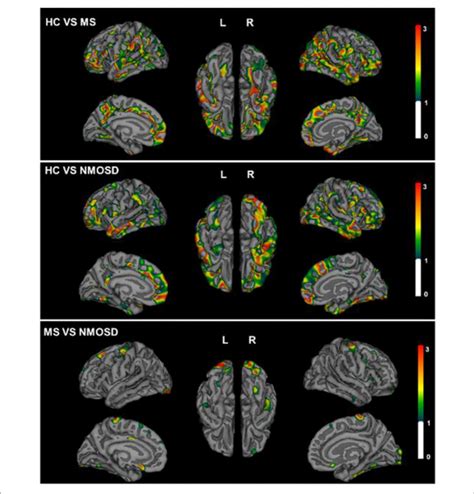 Topographical Distribution Of Group Differences In Cortical Thickness Download Scientific