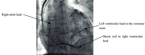 Biventricular Pacing With Icd Three Leads Right Atrial Lead Right
