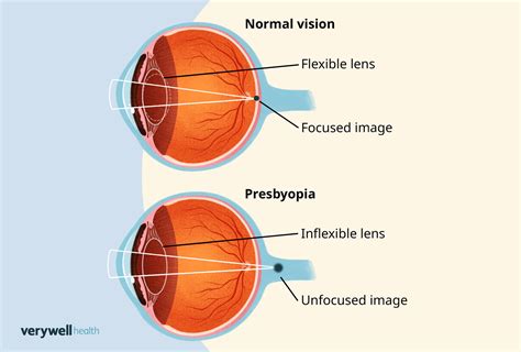 Presbyopia How Aging Affects Your Vision