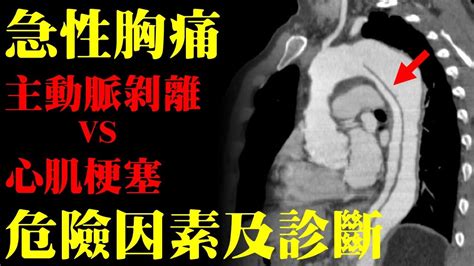 急性胸痛是主動脈剝離還是心肌梗塞診斷及危險因素許原彰醫師 YouTube