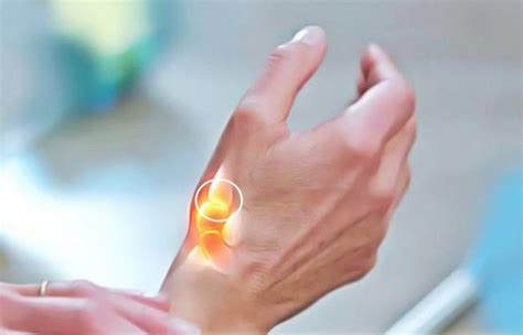 Rhizarthrose Arthrose De La Base Du Pouce