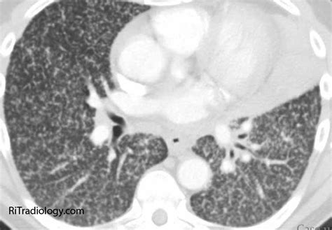 Rit Radiology Random Nodules