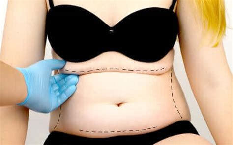 Co To Jest Abdominoplastyka Czyli Plastyka Brzucha Krok Do Zdrowia