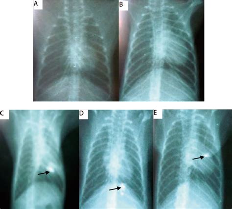 Bronchial Epithelial Hyperplasia Semantic Scholar