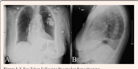 Acute Pericardial Effusion From Pacemaker Lead Perforation Of Right Ventricle Identified On