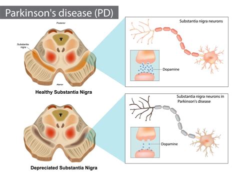 Managing Parkinsons