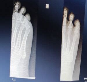 Toe Fractures Physiopedia