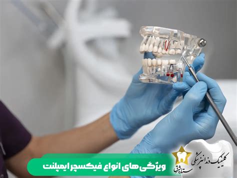 ویژگی‌های فیکسچر ایمپلنت هر آنچه باید بدانید