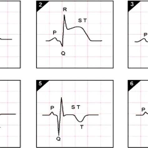 Ecg Signal Showing Myocardial Infarction Download Scientific Diagram