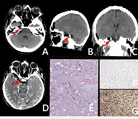 Postoperative Brain Ct And Histology A B C D Postoperative Brain Ct