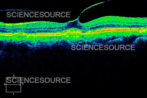 Epiretinal Membrane Oct Scan Stock Image Science Source Images