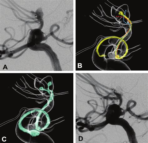 A A Right Ica Angiogram At Working Projection After The Introduction Download Scientific