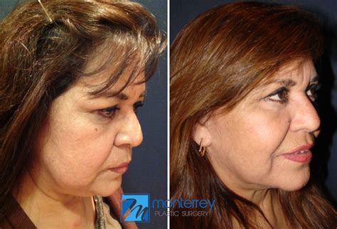 Facelift Gallery Monterrey Mexico Plastic Surgery