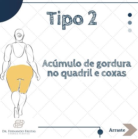 Quais Os Tipos De Lipedema Dr Fernando Responde