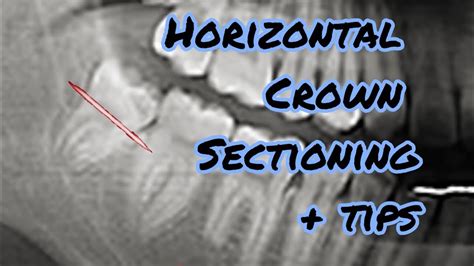 Mesioangular Wisdom Tooth Extraction Step By Step Drwahan Youtube