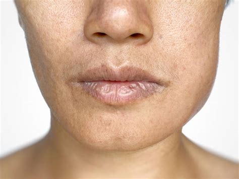 Abscess Tooth Swollen Cheek