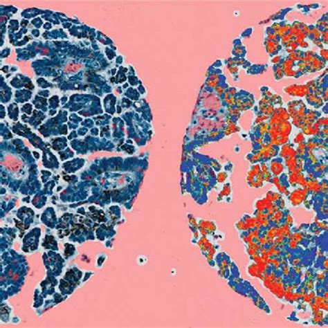 Matrix Metalloproteinase 14 Immunostaining Tissue Microarray Spot
