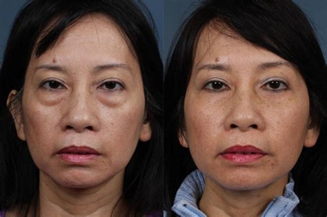 Fat Transfer Before And After Photo Gallery Louisville Ky Calospa