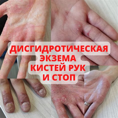 Дисгидротическая экзема Советы дерматолога Sovetydermatologa Дзен