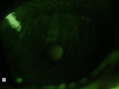 Foreign Body Tracks Point To The Problem Sonoran Desert Eye Center