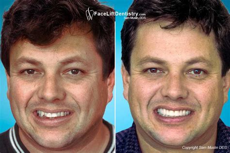 Gap Between Top And Bottom Teeth