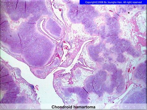 Pulmonary Chondroid Hamartoma Ppt