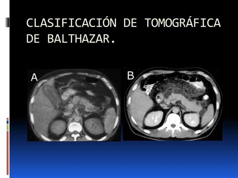 Ppt Pancreatitis Aguda Powerpoint Presentation Free Download Id