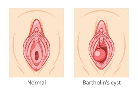 Comparing Normal Vs Sick Female Reproductive Organs On Perineum Surface