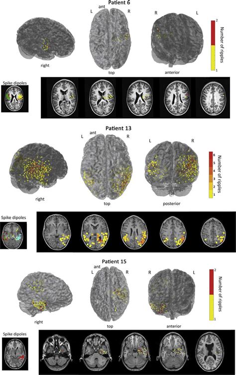 Ripple Results For Three Patients Ripples Are Visualized In A 3d Download Scientific Diagram