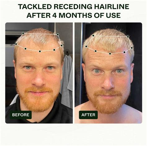 Scandinavian Biolabs Hair Growth System For Men Clinically Proven