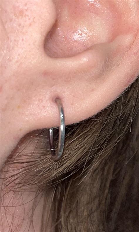 Keloid Steroid Injections R Keloids
