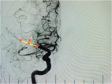 Assessment Of Clot Length With Multiphase Ct Angiography In Patients