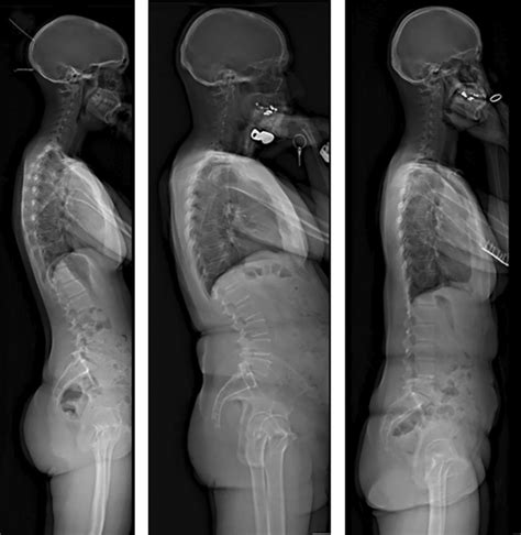 Spinal Alignment Varies With An Individuals Race Sardar Spine Top Spinal Disorders Surgeon