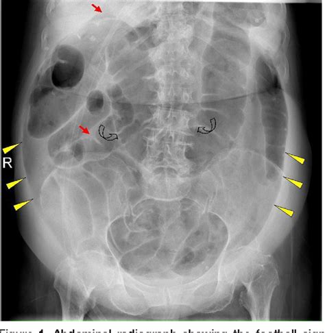 Figure 1 From Massive Pneumoperitoneum After Colonoscopy Semantic