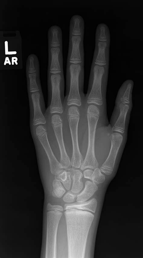 Boneage Object Detection Model By Bond Gg