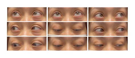 Ophthalmology Dx Double Vision After Collision Ophthalmology Advisor