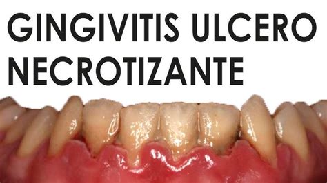 Gingivitis Ulcerosa Necrosante